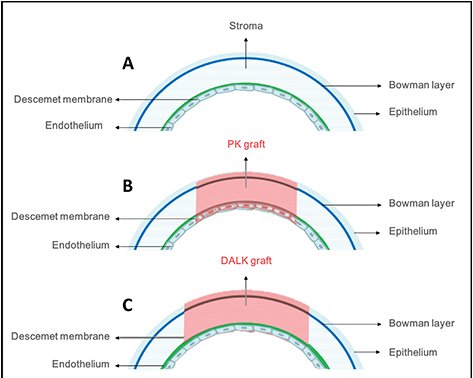 Seguridad y eficacia de queratoplastia lamelar anterior profunda versus ...