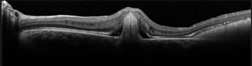 OCT en Distrofia Macular Viteliforme - Qvision