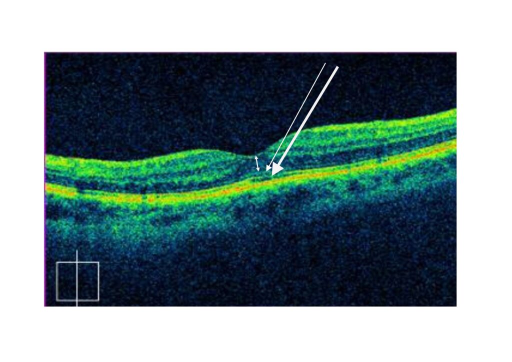 Importancia de la OCT en pacientes operados de desprendimiento de ...