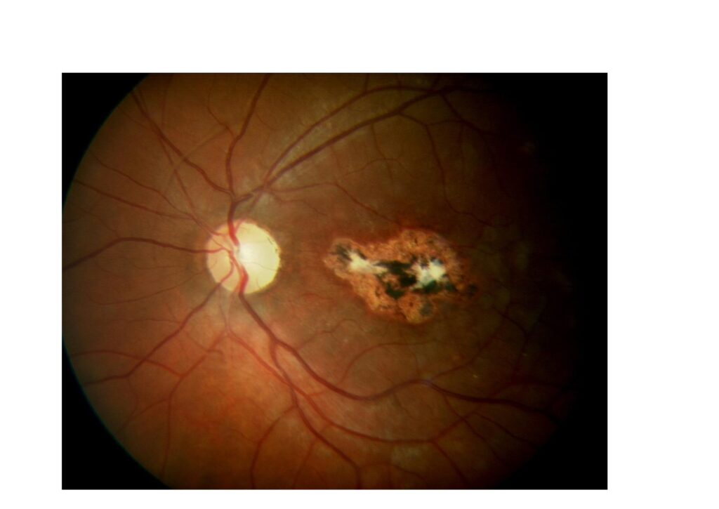 ¿Pueden prevenirse las recurrencias de coriorretinitis por toxoplasma ...